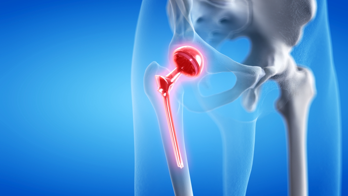 How to Tell When Your Hip Implant is Defective - James Morris Law Firm P.C.